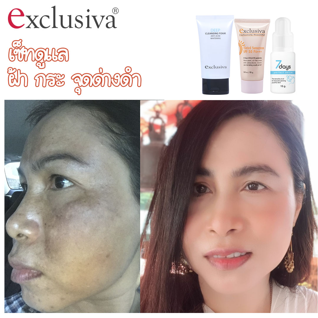 เอ็กซ์คลูซีว่า เซ็ท ลดฝ้า กระ จุดด่างดำ Anti melasma SET Exclusiva